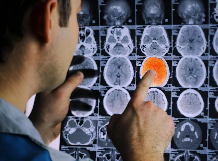 Ischemic Stroke: Causes, Symptoms and Treatment